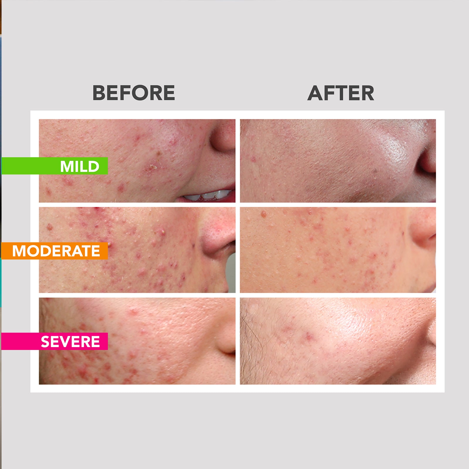 Acne Wipeout® Clinical Acne System